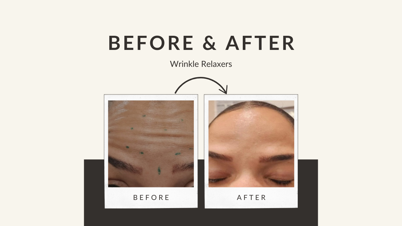 Wrinkle Relaxers | Iris Medical Aesthetics