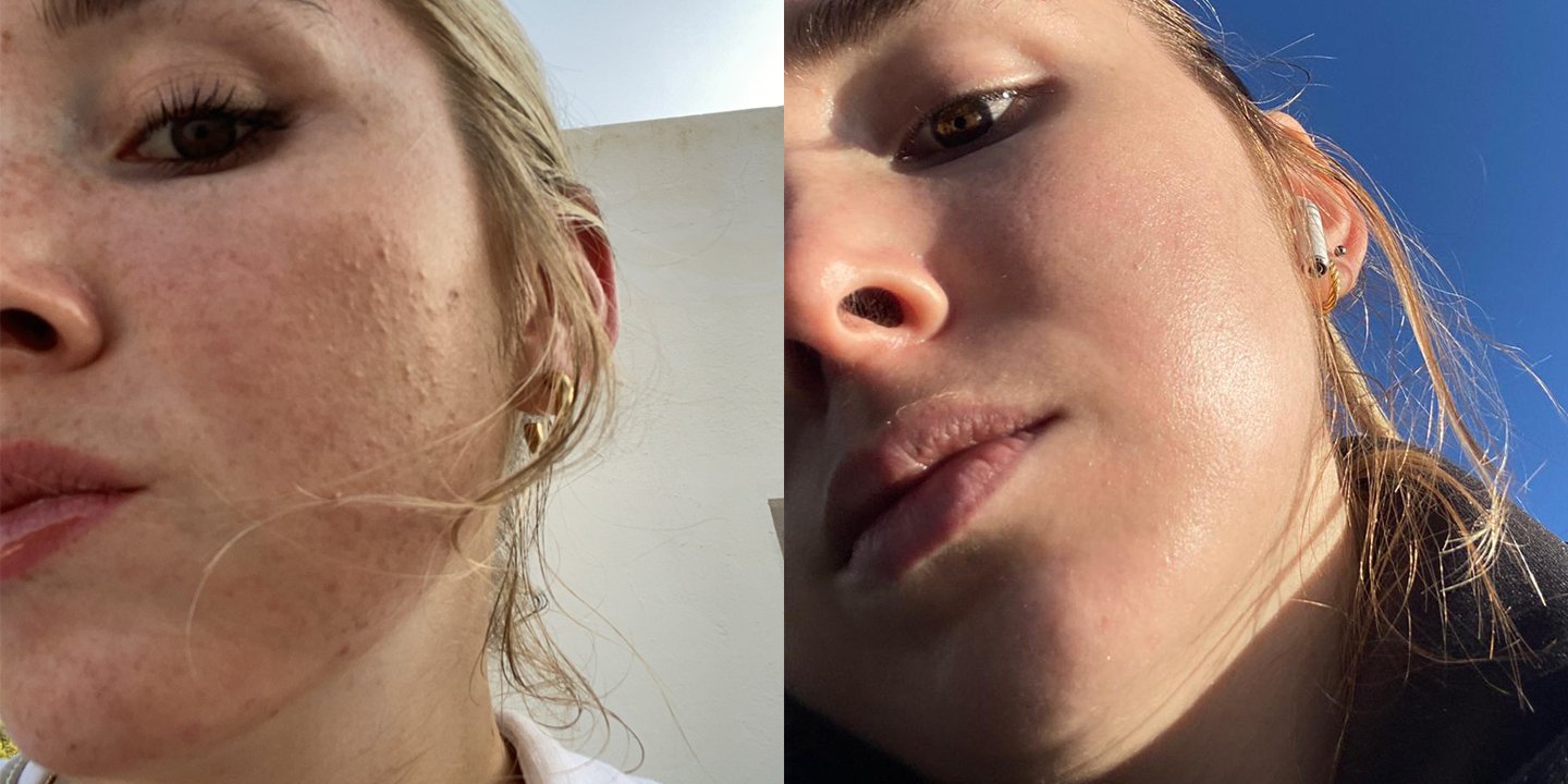 Guide: How to start using a retinoid to treat skin texture and acne - Payhip