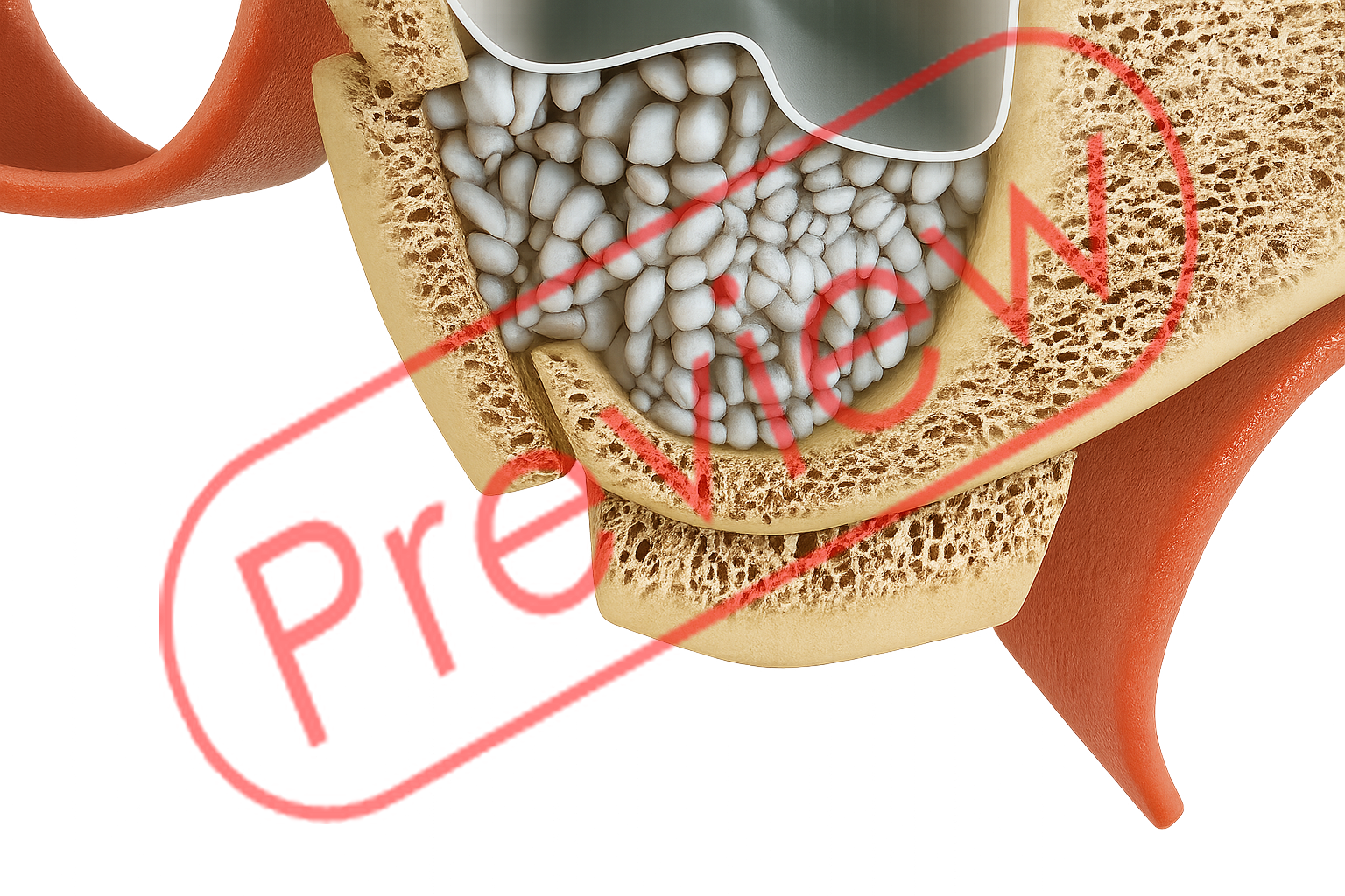 Dental Figure 4236y44 Implants Bone Graft Sinus Lift - Payhip