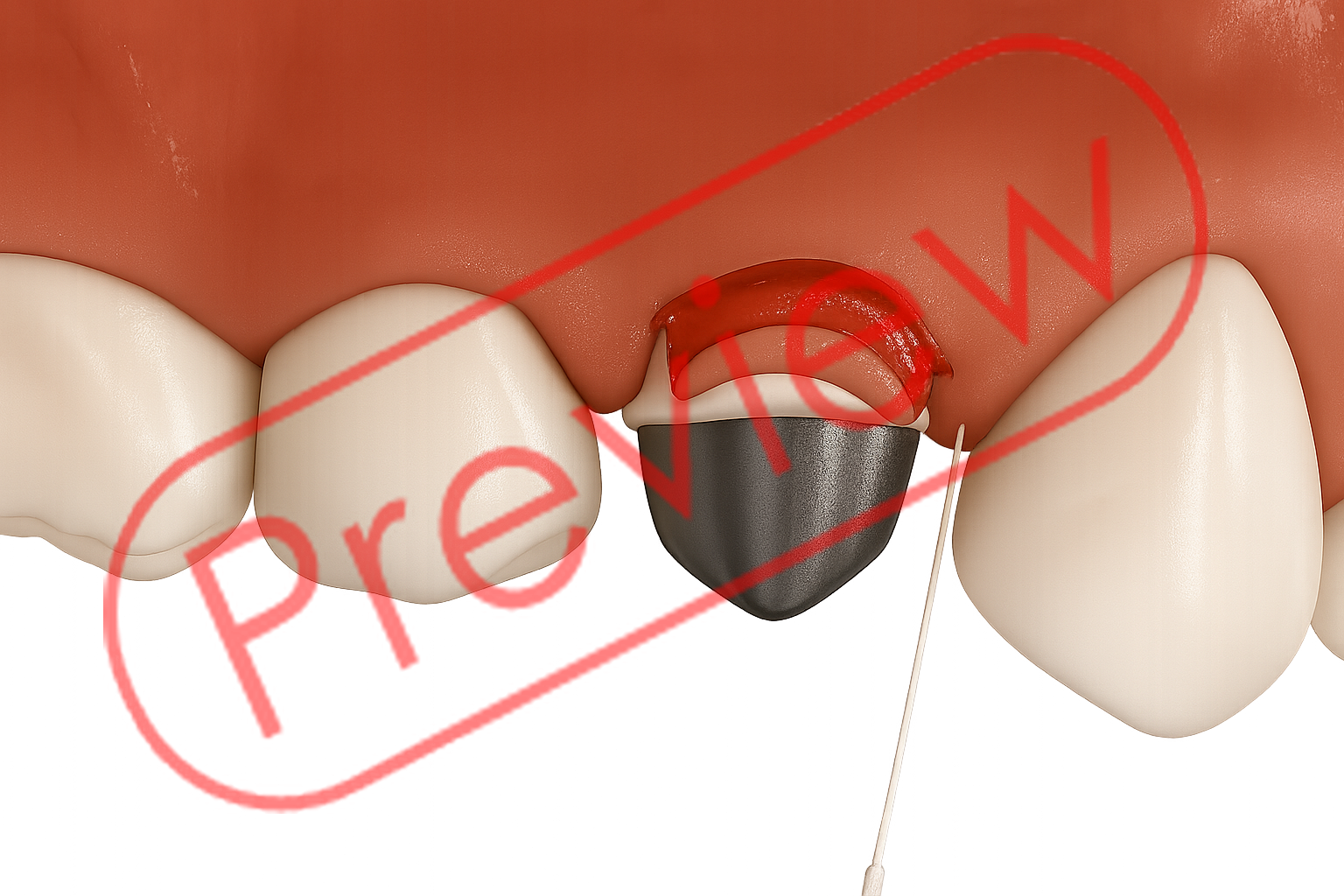 Dental Figure 5883ed Crown and Bridge - Payhip