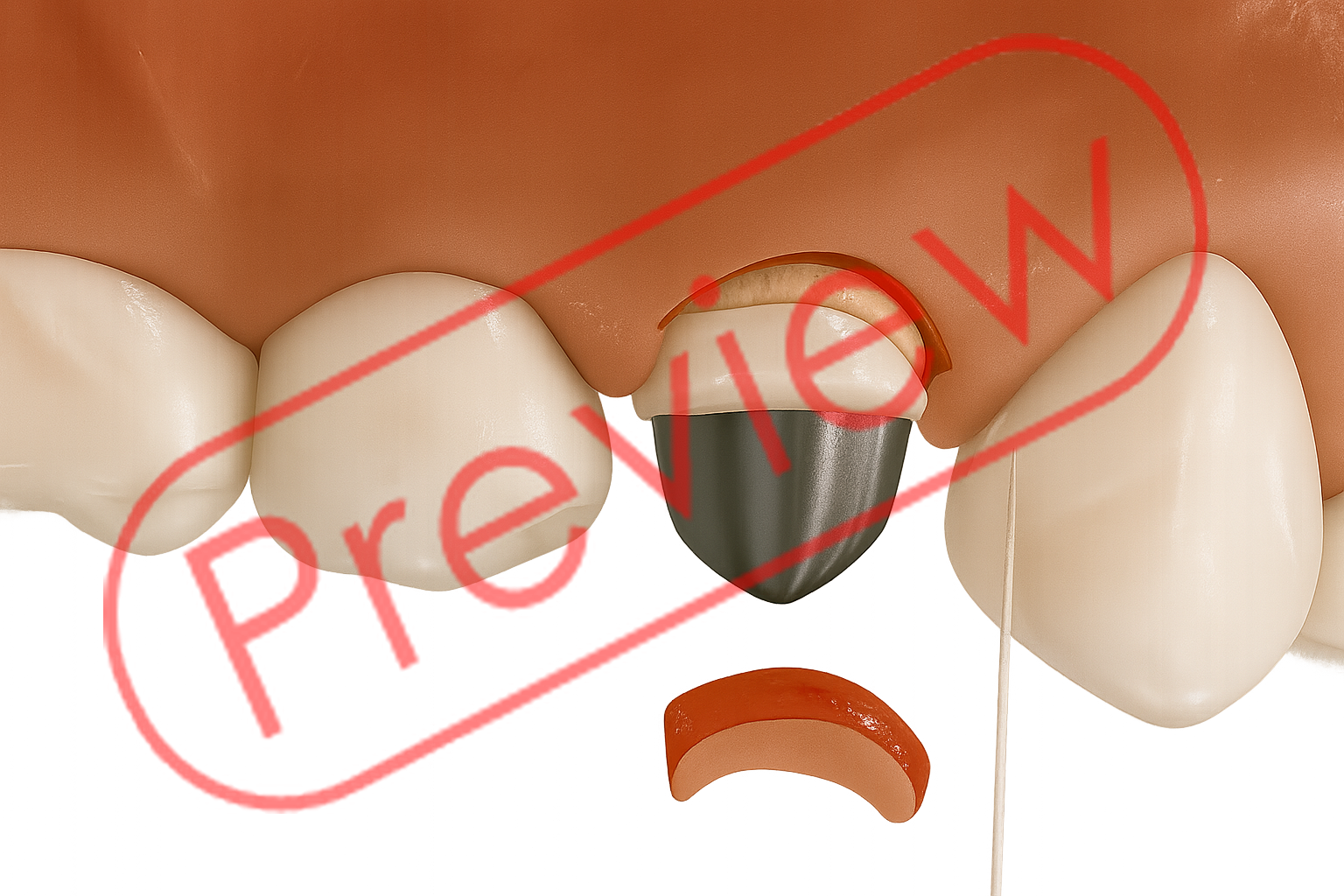 Dental Figure 5883ed3 Crown and Bridge - Payhip