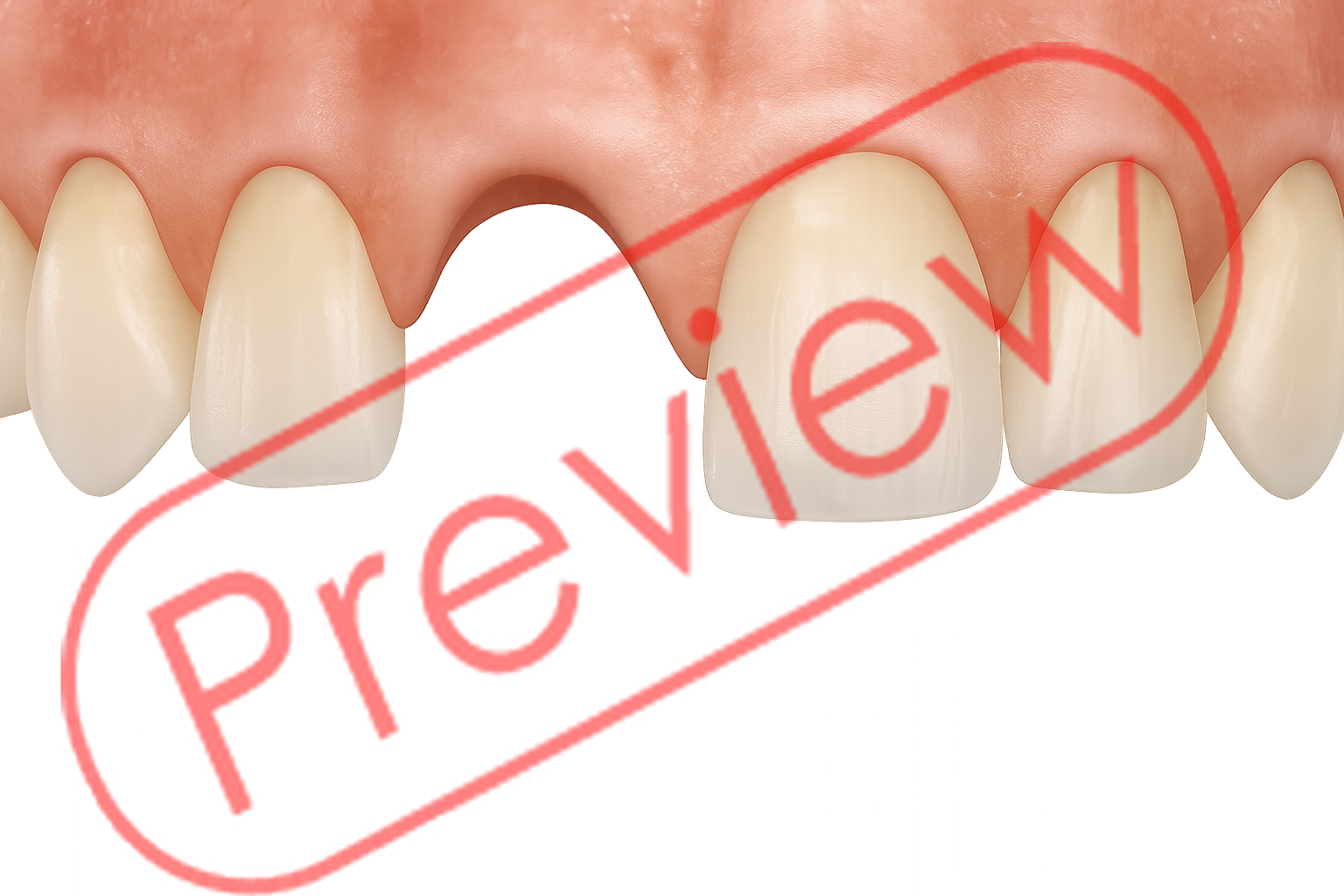 Dental Figure 66r236 Surgery Implant Bone Graft - Payhip