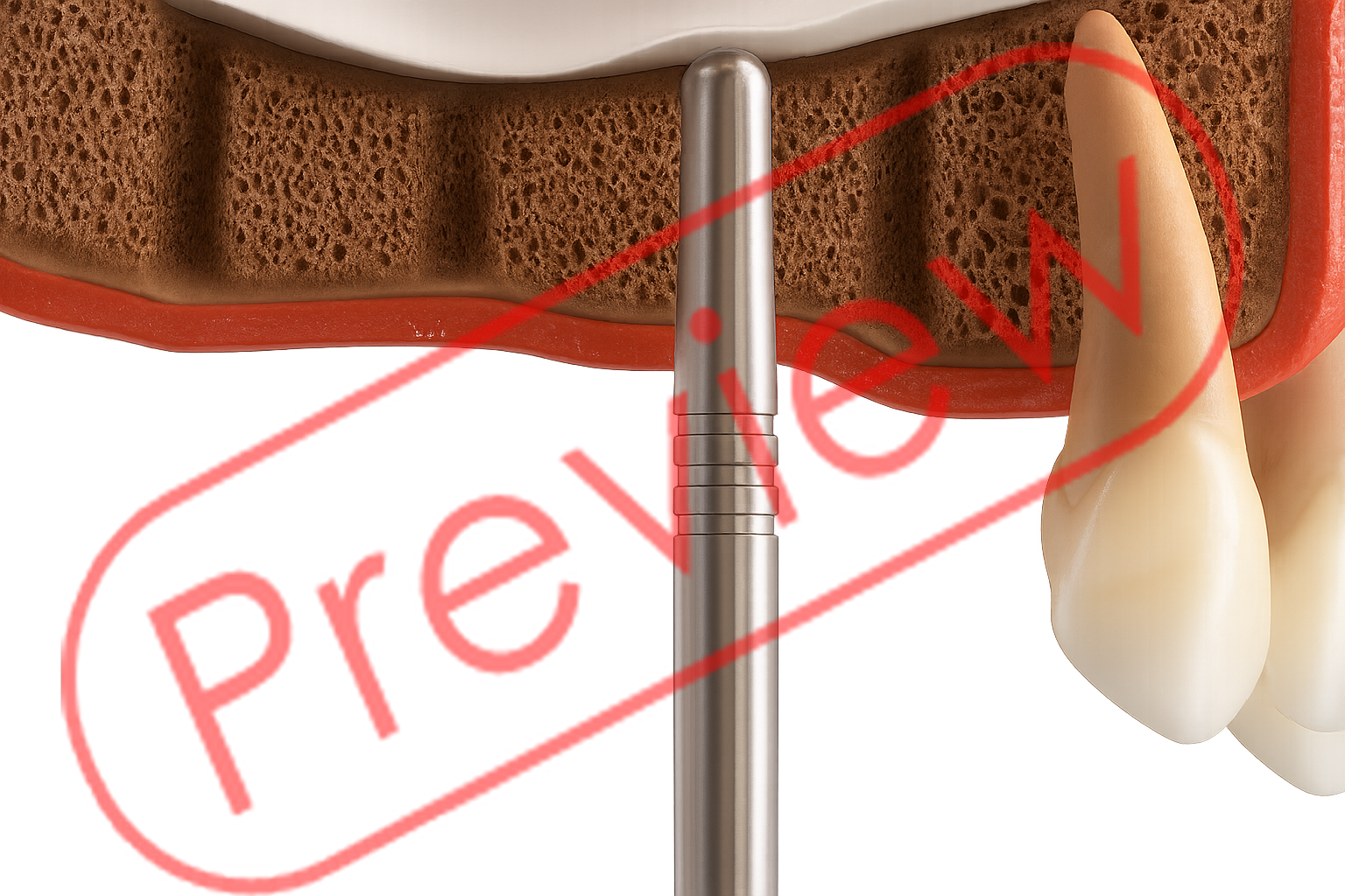 Dental Figure y55 Surgery Implant Bone Graft Sinus Lift - Payhip