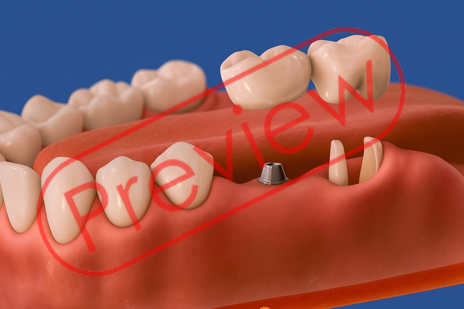 Dental Figure 6wz Implant Surgery crown bridge - Payhip