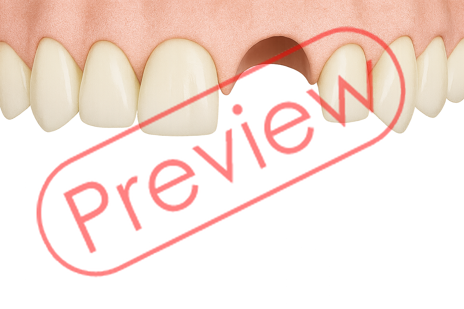 Dental Figure p065 Crown bridge crowns and bridges - Payhip