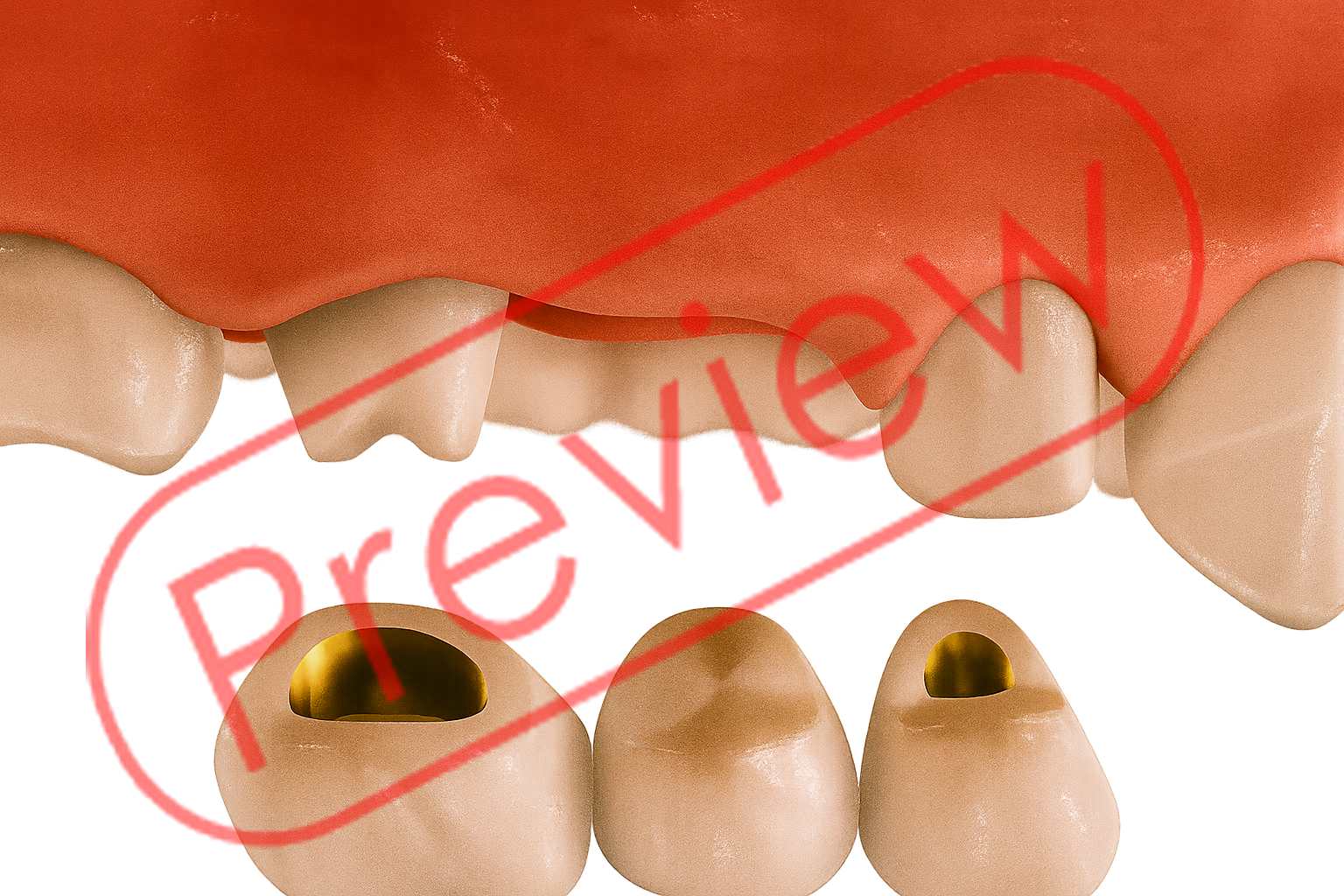Dental Figure b764x Crown bridge crowns and bridges - Payhip