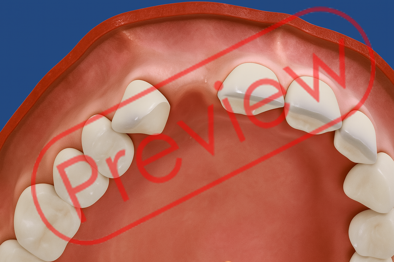 Dental Figure 5r2 Crown bridge crowns and bridges - Payhip