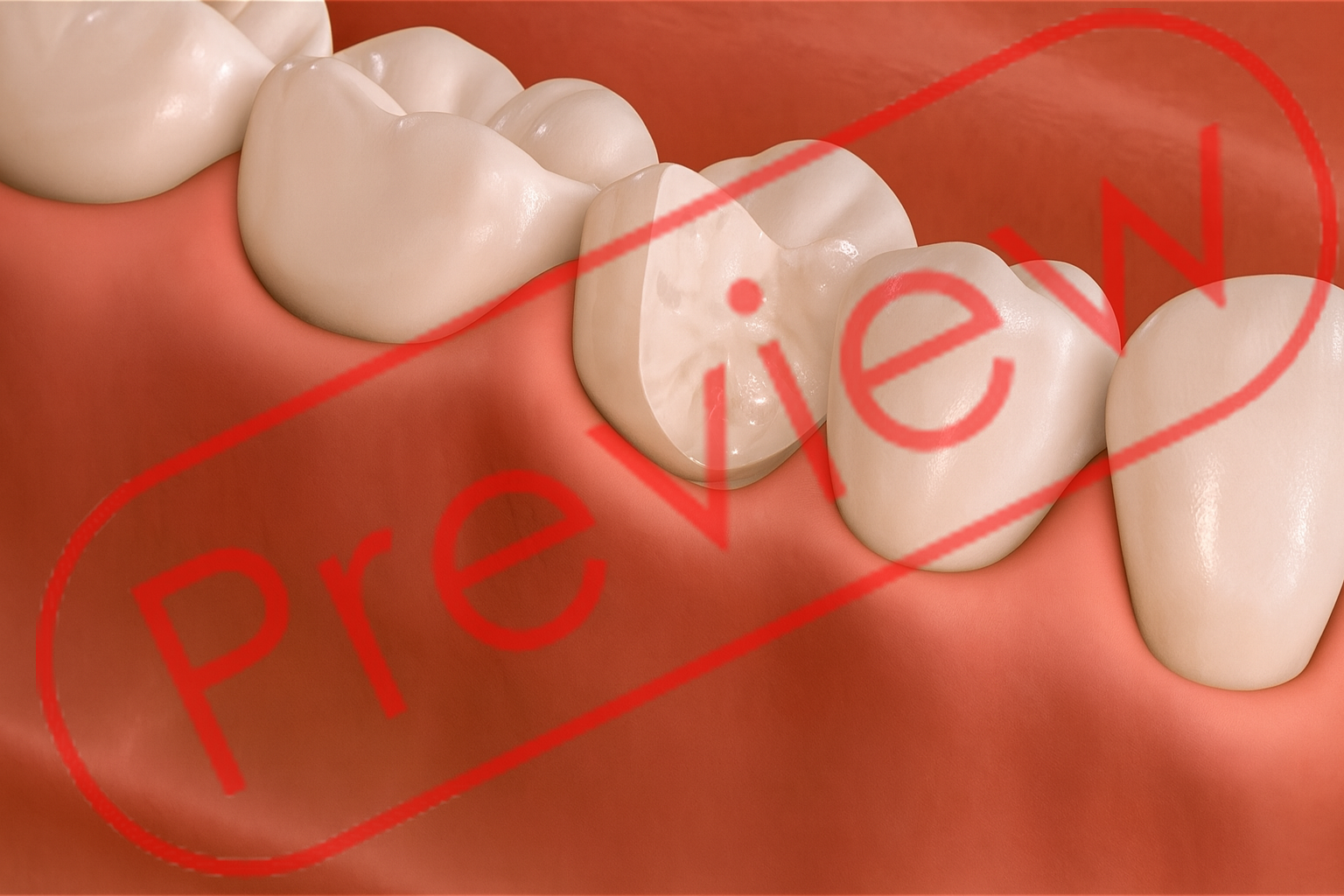 Dental Figure b66494 Crown bridge crowns and bridges - Payhip