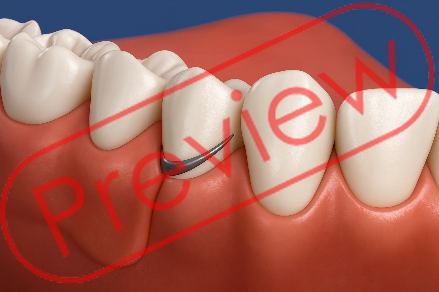 Dental Figure Denture 0086 - Payhip