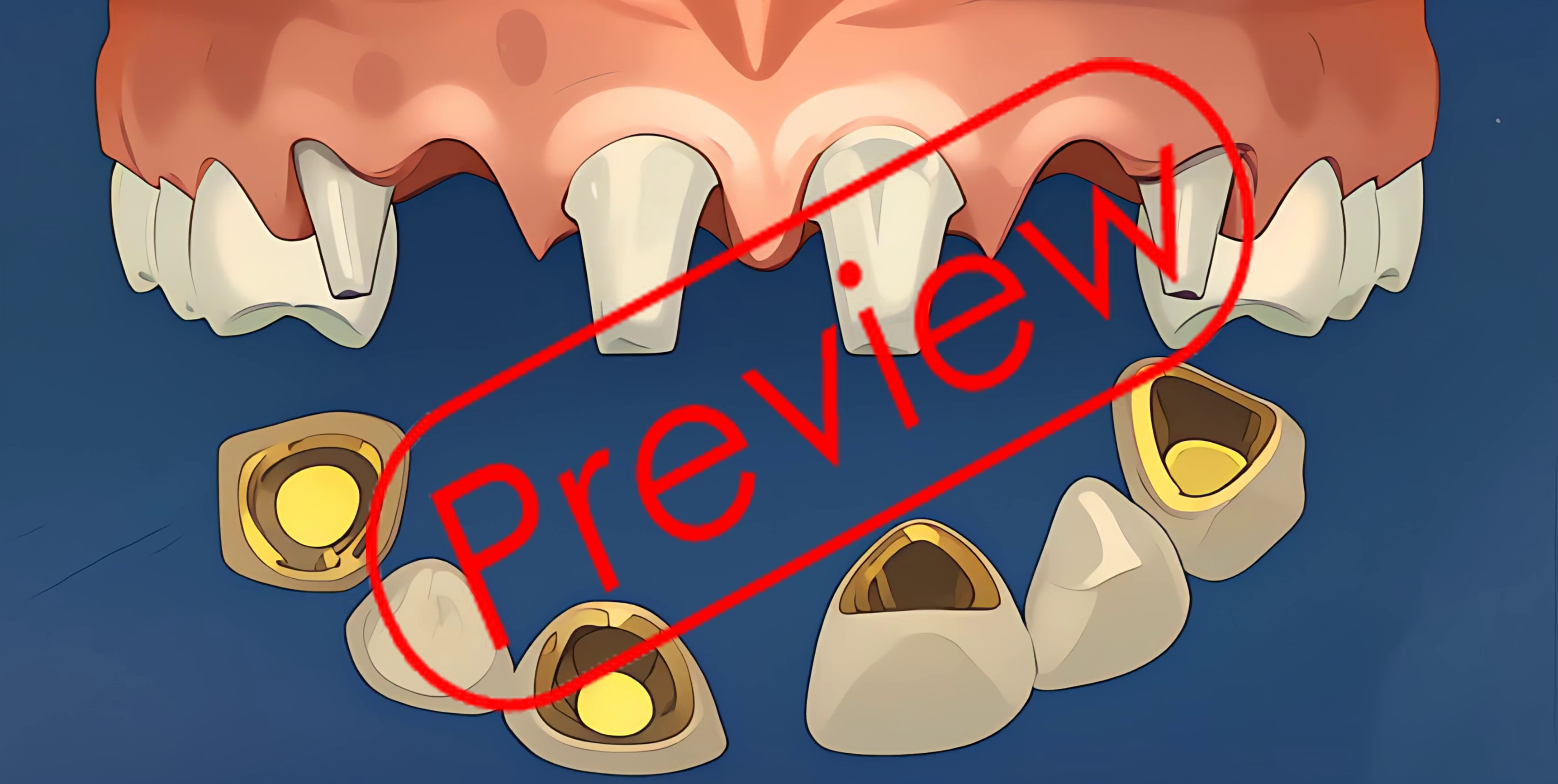 Dental Anime Denture Crown 3uw223 - Payhip
