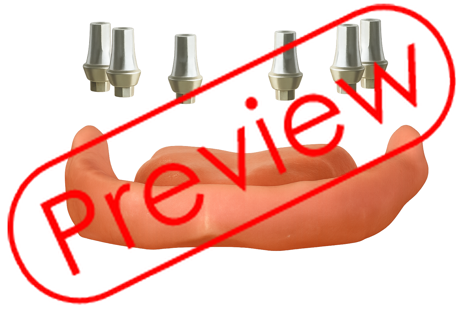 All on Full Restoration Implants 2io8d456 - Payhip