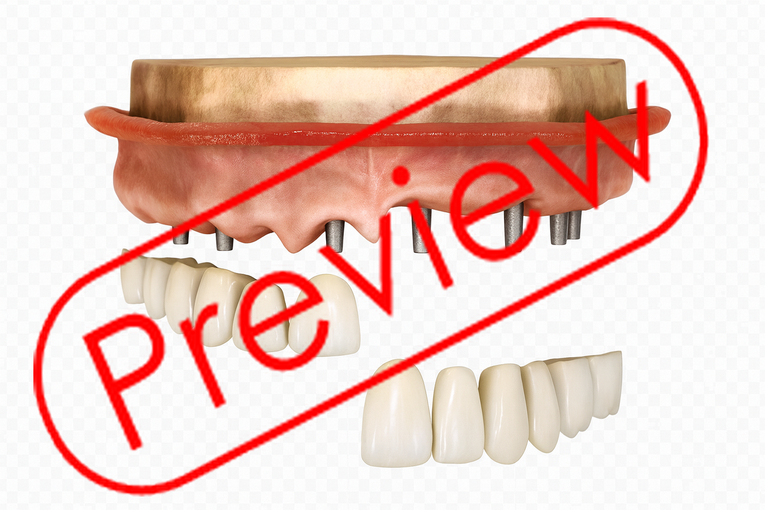 All on Full Restoration Implants 2dcvc1x - Payhip